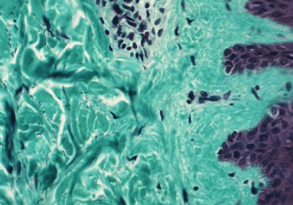 How Hydrolyzed Collagen Type One Promotes Wound Healing | Sanara MedTech